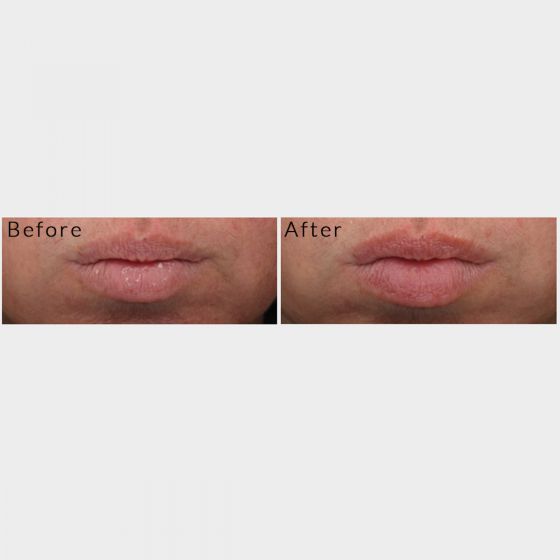 SkinMedica® HA5 Smooth & Plump Lip System | Dermatology Specialists ...